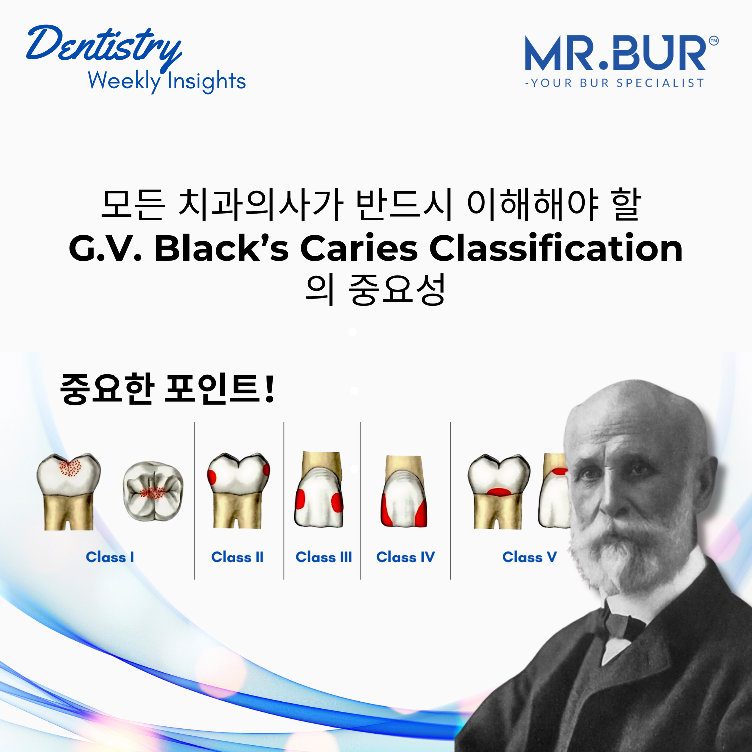 모든 치과의사가 반드시 이해해야 할 G.V. Black's Caries Classification의 중요성 – Mr Bur Korea